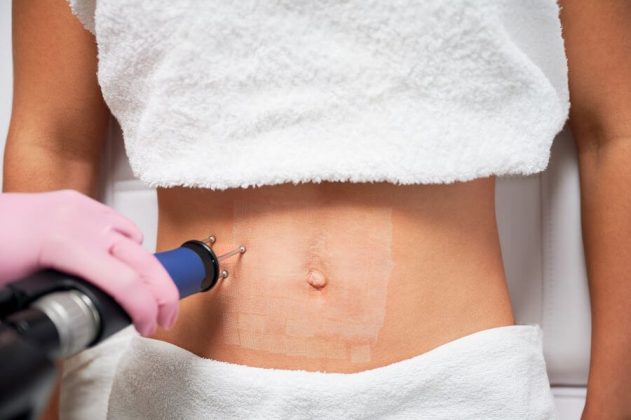 The Ultimate Guide To CO2 Laser For Stretch Mark Removal | The Leisure ...